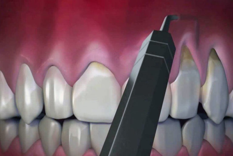 Pinhole Surgical Technique New Jersey Irie Dental Associates